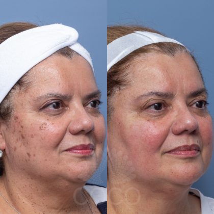 Pigmentation Treatment Perth | Dark Spots & Melasma | COCO